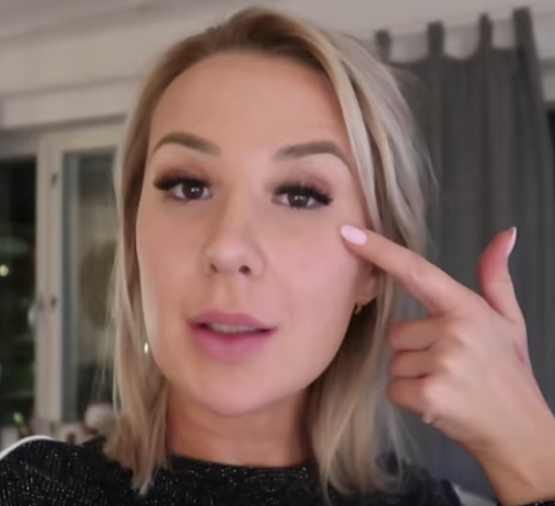 Alexandra "Kissie" Nilsson har tagit ut sina fillers