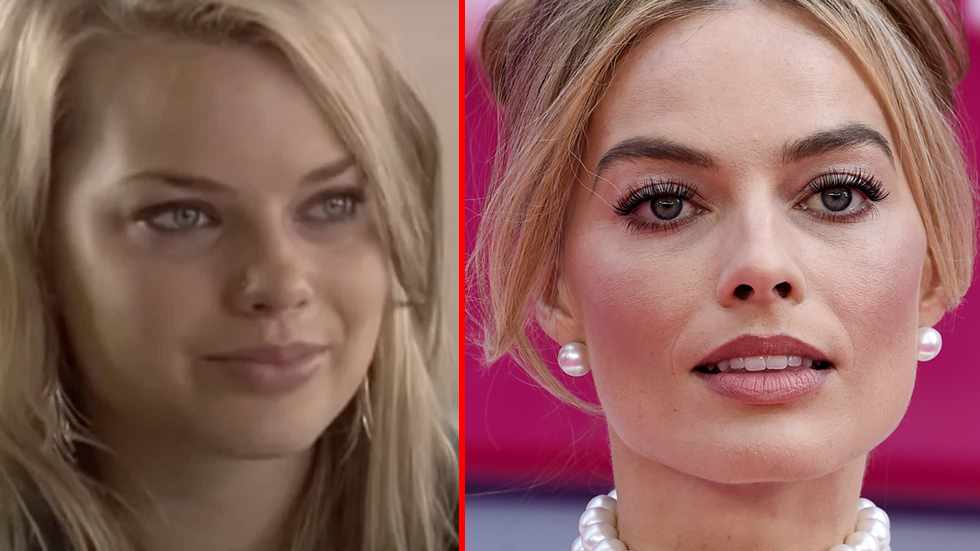 Buccal fat removal: 11 kändisar före och efter operationen